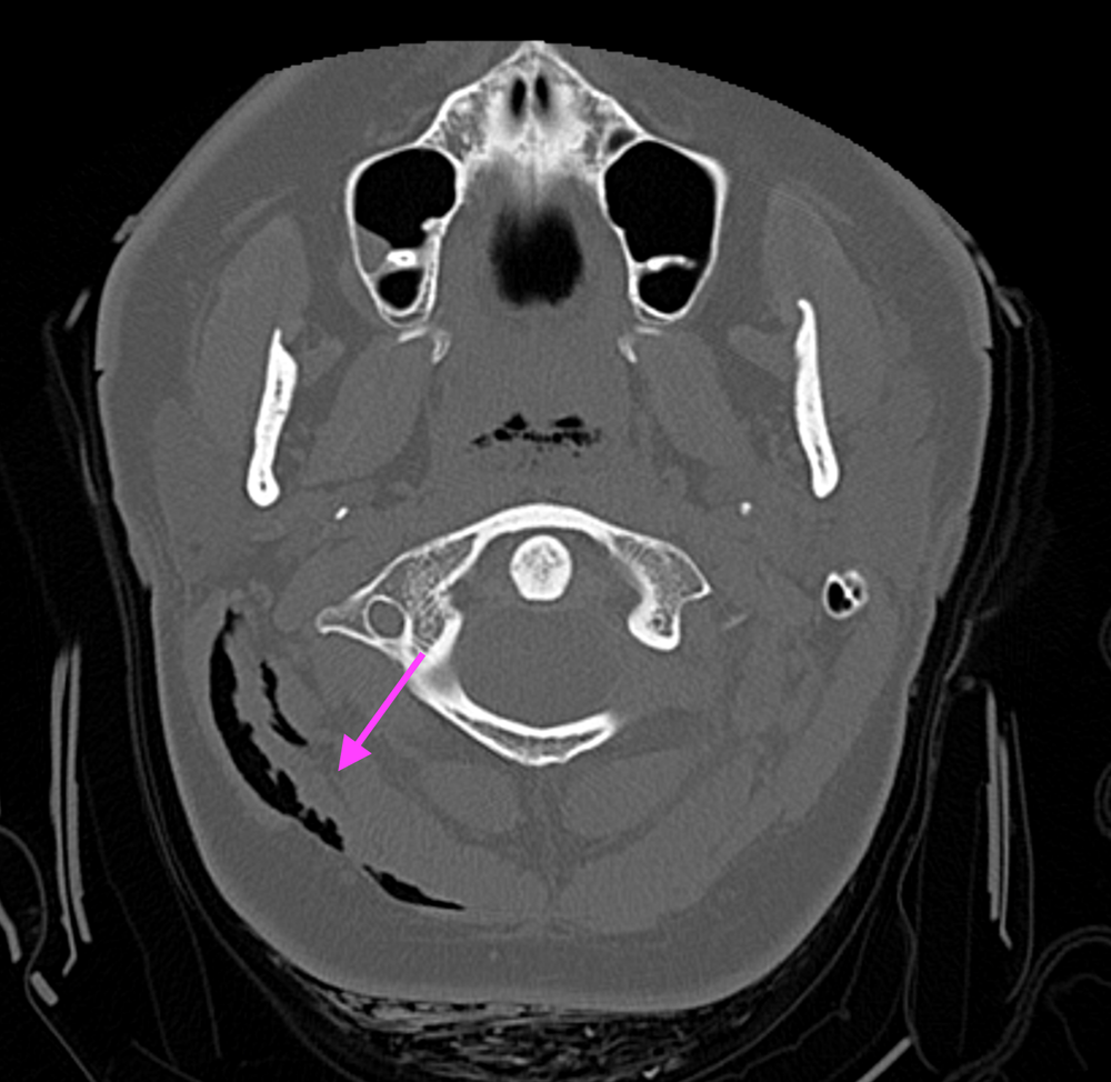 Scalp laceration