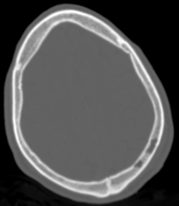 Skull lesions