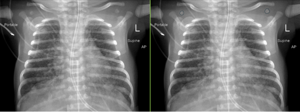 Neonatal chest radiograph - imaging hints of preterm versus term birth